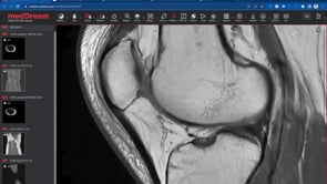Tear of prepatellar quadriceps continuation · MSK Radiology