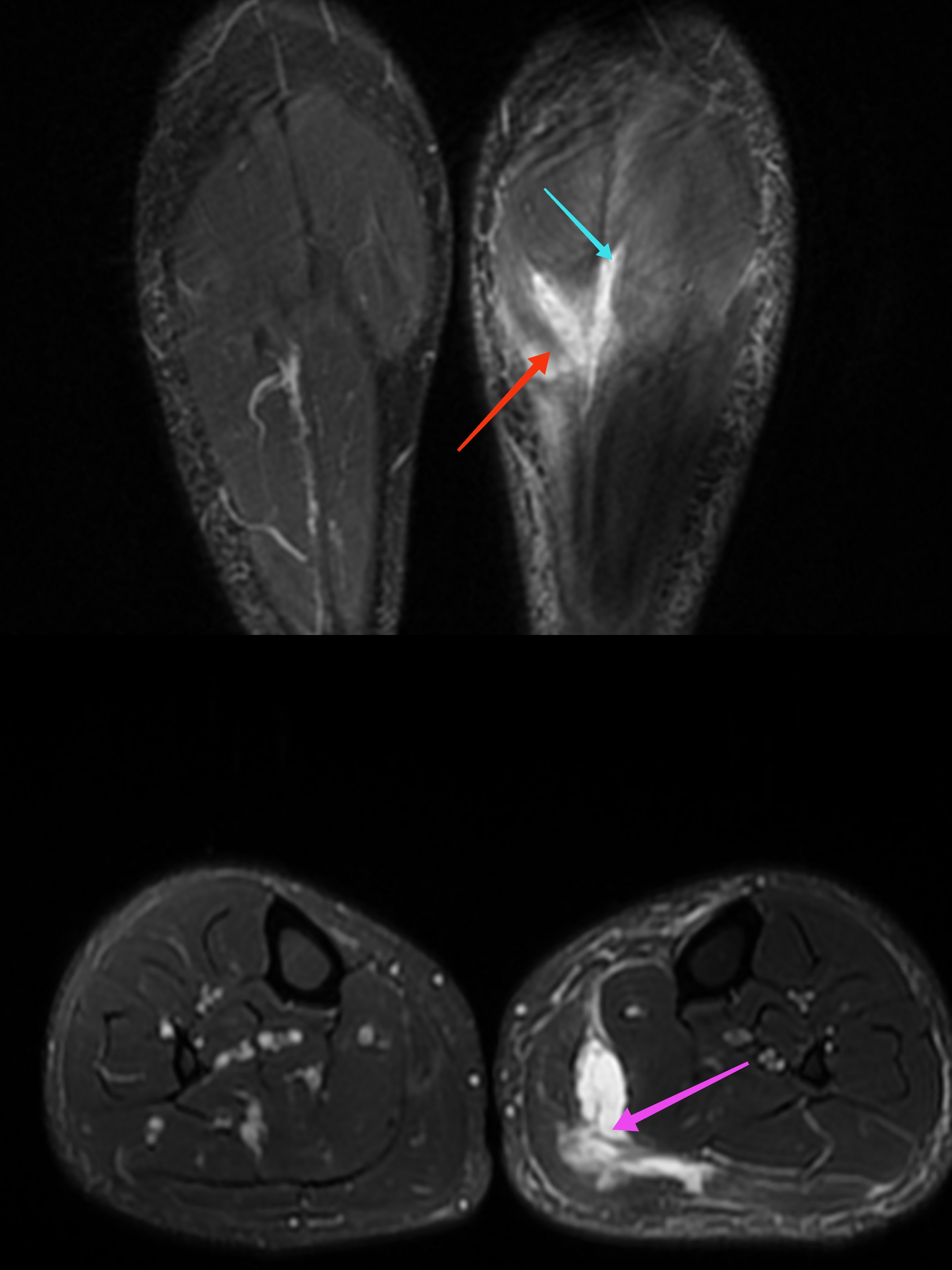 TENNIS LEG CASE · MSK Radiology School