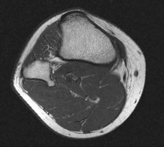 Prominent posterior bony outpouching in the proximal fibula · MSK Radiology