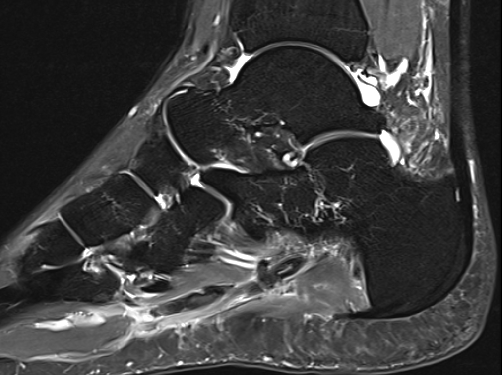 Plantar vein thrombosis · MSK Radiology