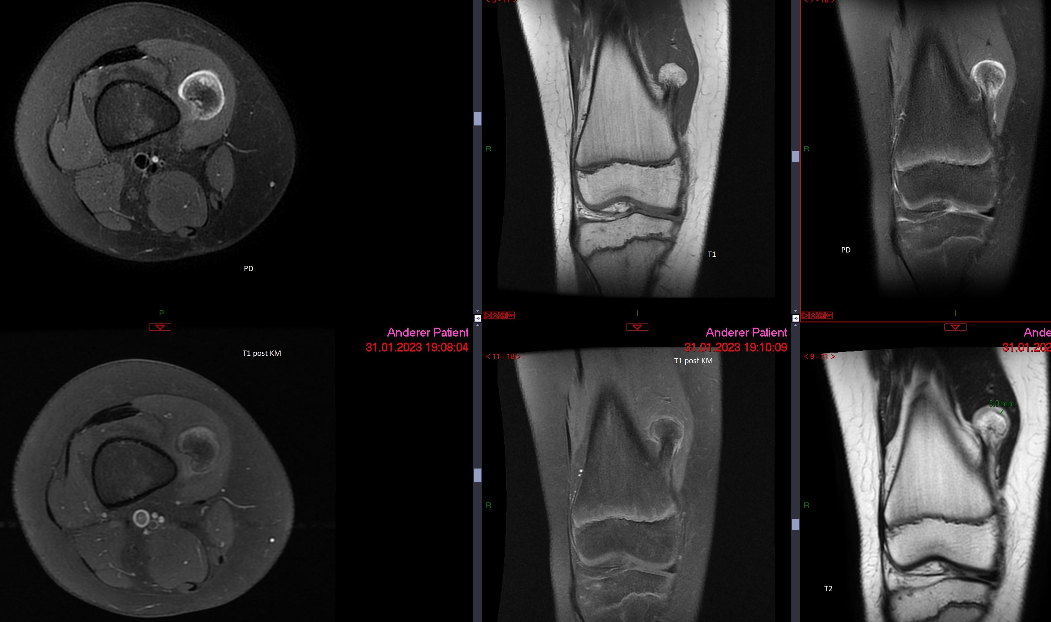 Case of painless medial sided swelling of the knee · MSK School (Free)
