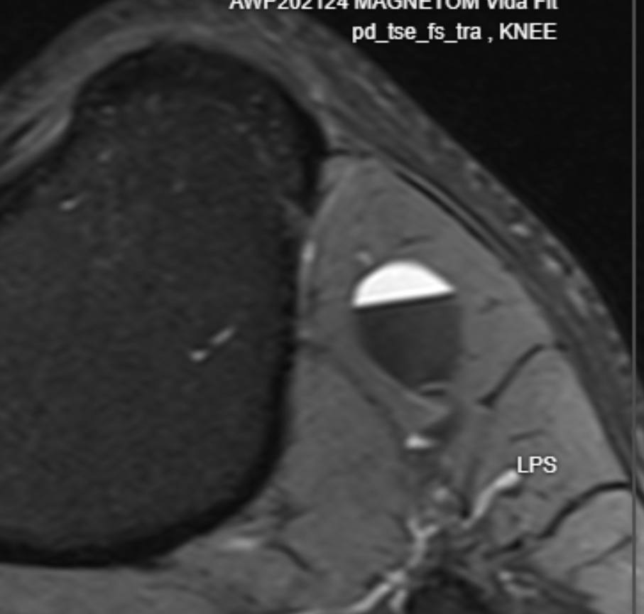 Intramuscular cyst. · MSK Radiology
