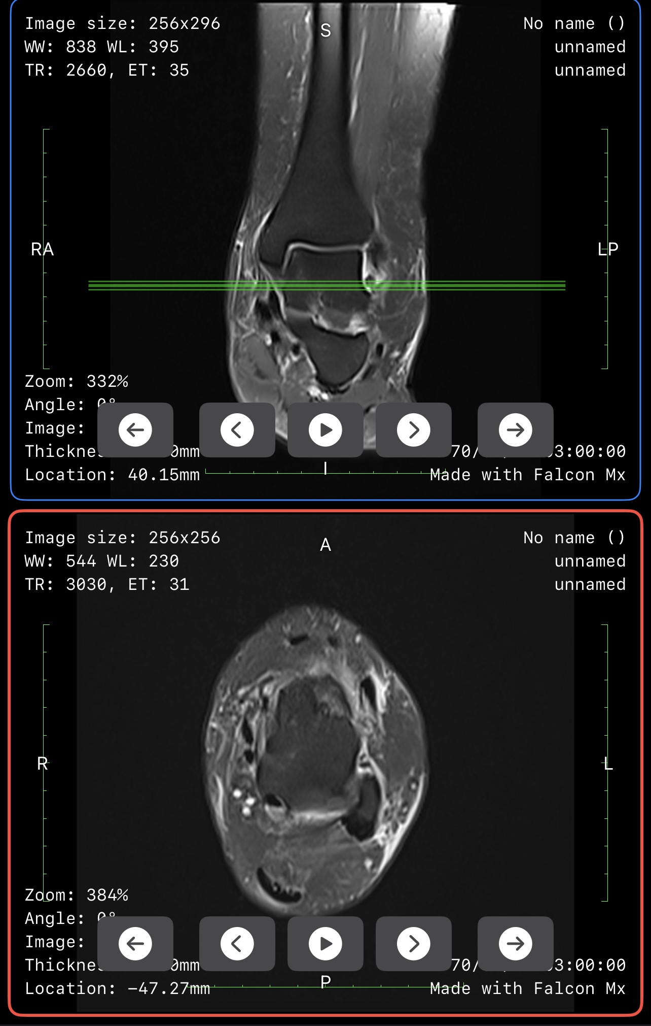Ankle mri · MSK Radiology