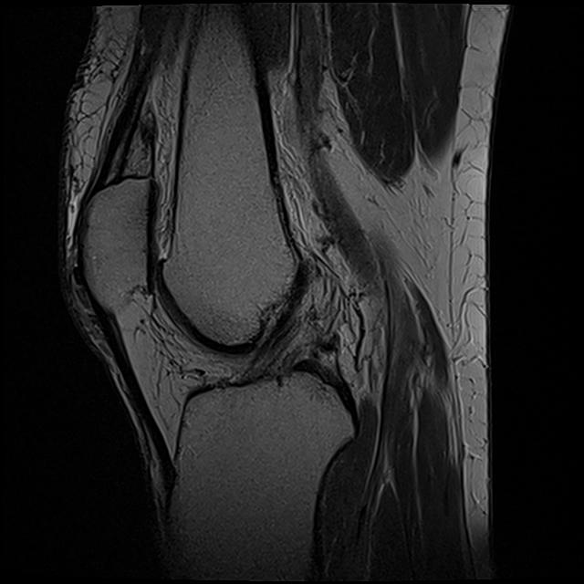 Absent PCL · MSK Radiology