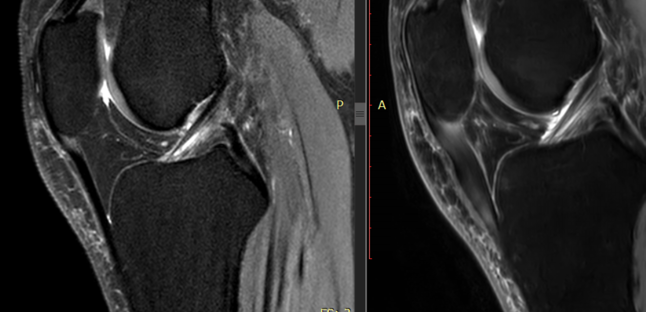 fast development of tendinosis · MSK Radiology