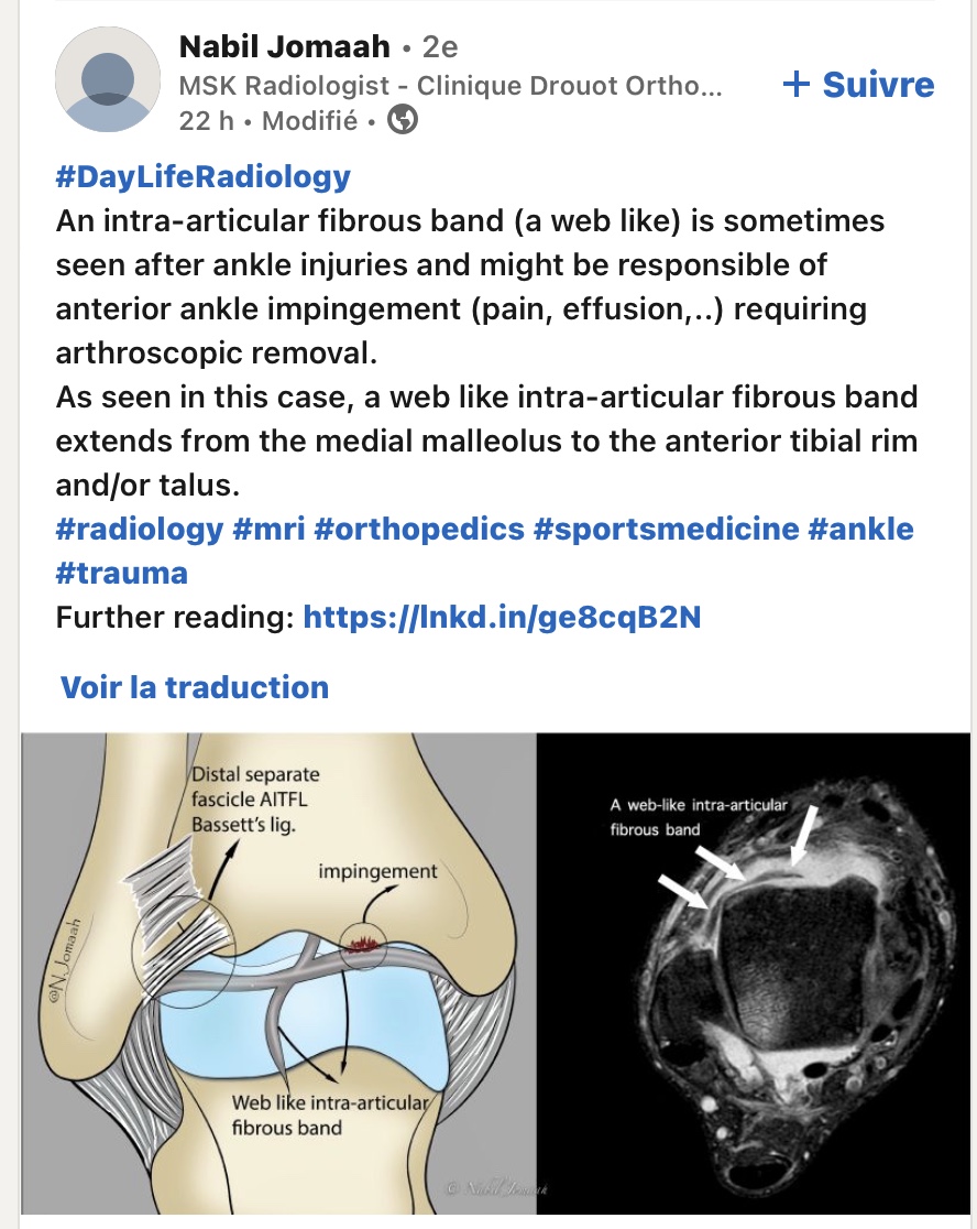Intra articular fibrous band · MSK Radiology