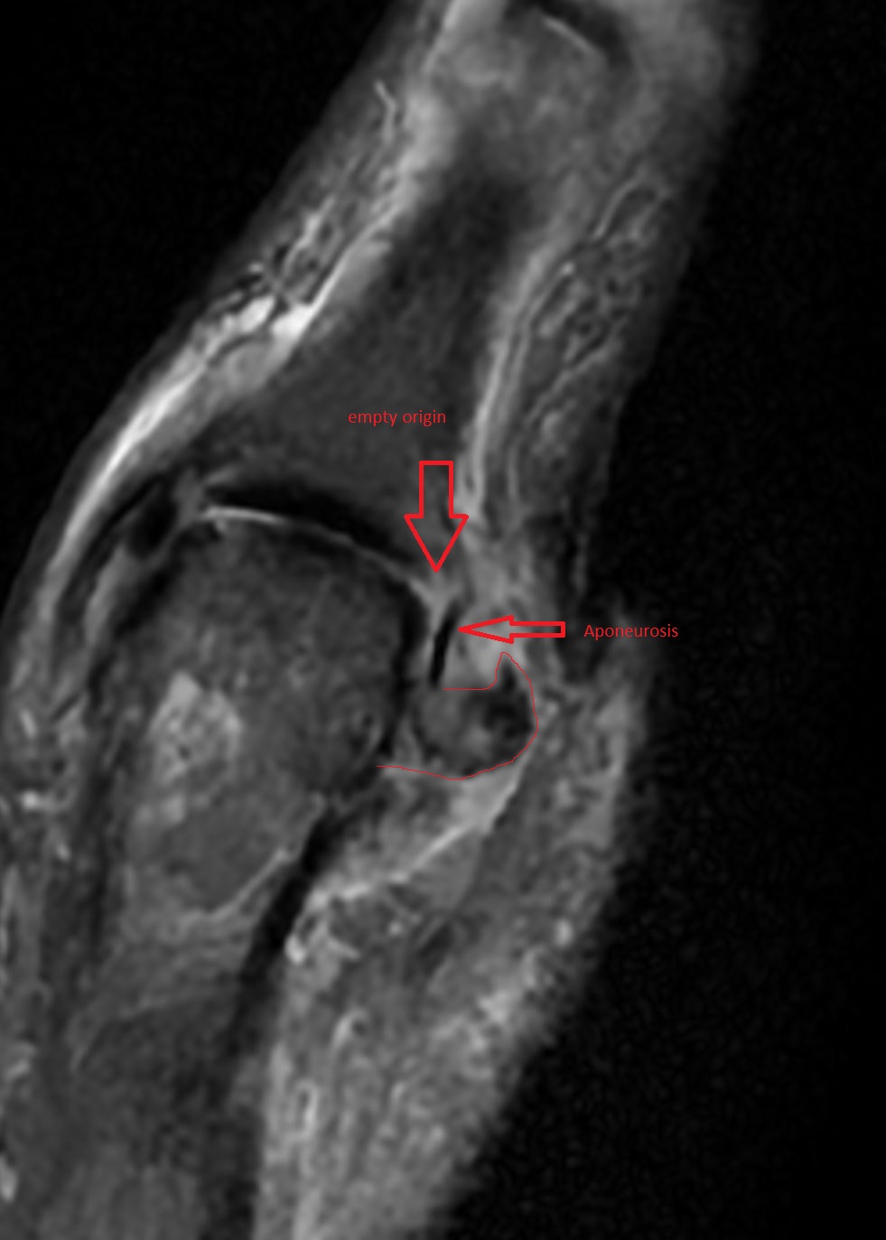 Stener's lesion - yes or no explained in 2 images · MSK Radiology