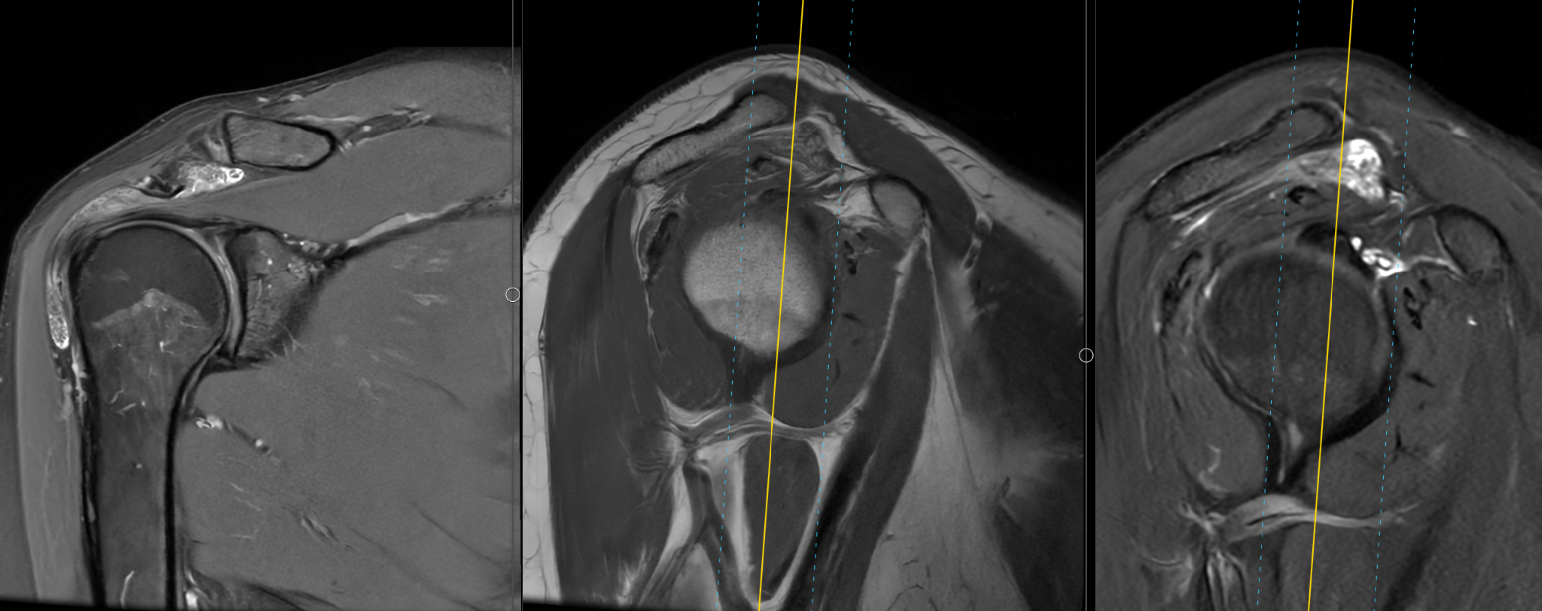 Interesting Shoulder Case · MSK Radiology