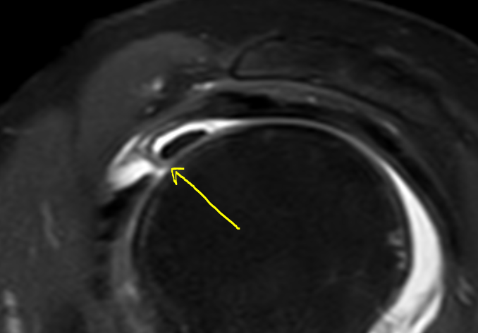 Nice Biceps-Pulley on Arthro-MRI · MSK Radiology