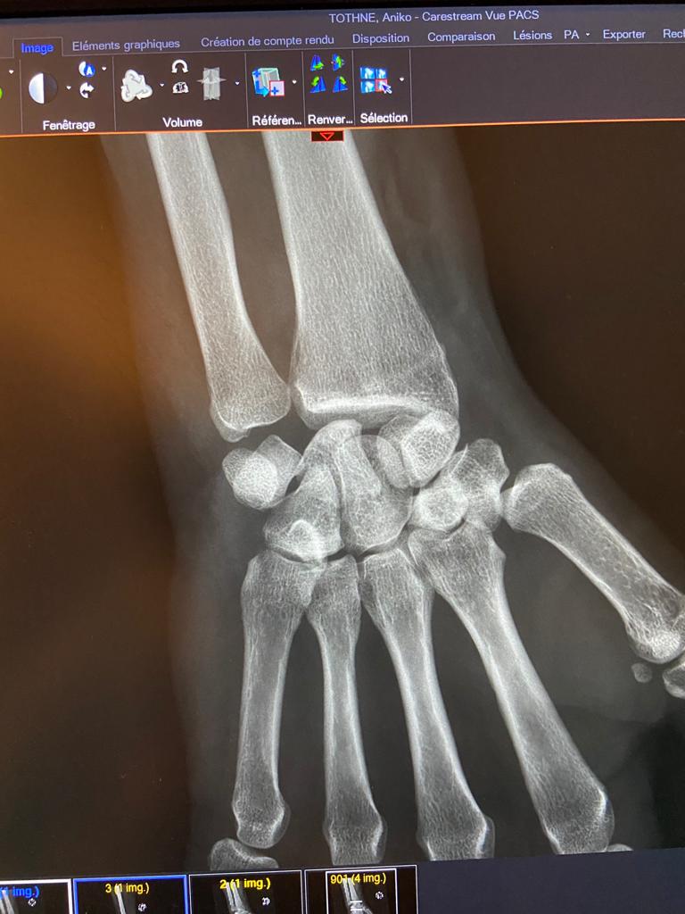 FOOSH · MSK Radiology