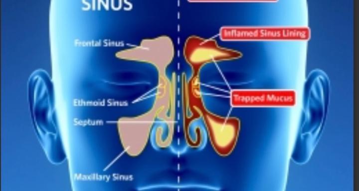 Chronic Rhinosinusitis Program