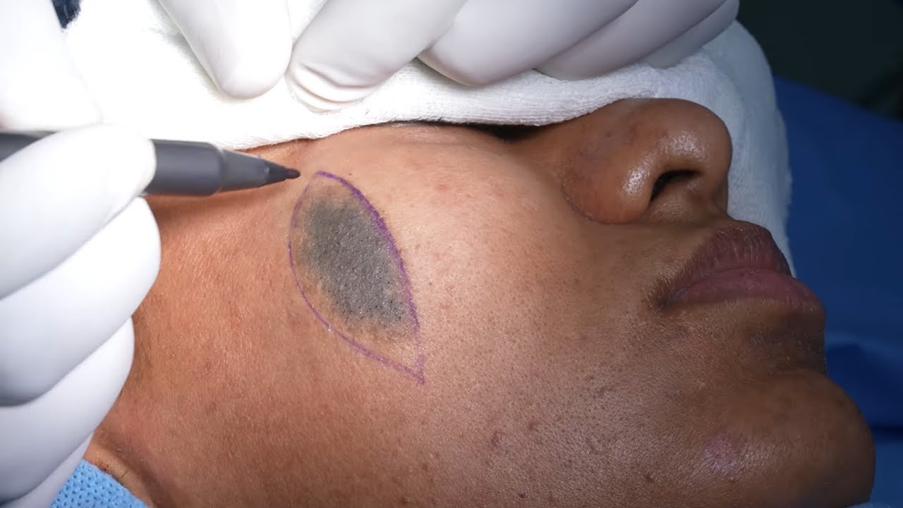 Nevus Excision - Procedures skills · Medicoplasty OSCE