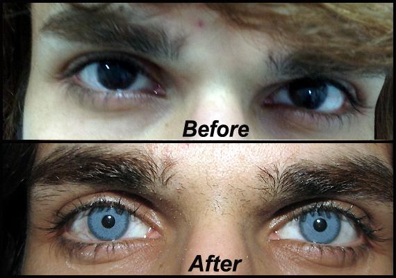 Eye Lightening & Color Change